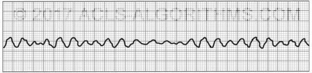 Ventricular fibrillation | ACLS-Algorithms.com