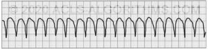 Pulseless ventricular tachycardia | ACLS-Algorithms.com