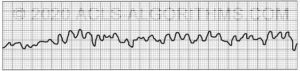 Ventricular fibrillation | ACLS-Algorithms.com