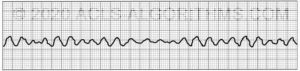 Ventricular fibrillation | ACLS-Algorithms.com