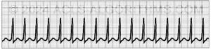 EKG Practice Test 2 - Learn & Master ACLS/PALS